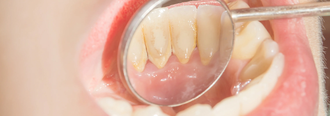 How To Remove Tartar at Home Naturally? - Dr. Motiwala