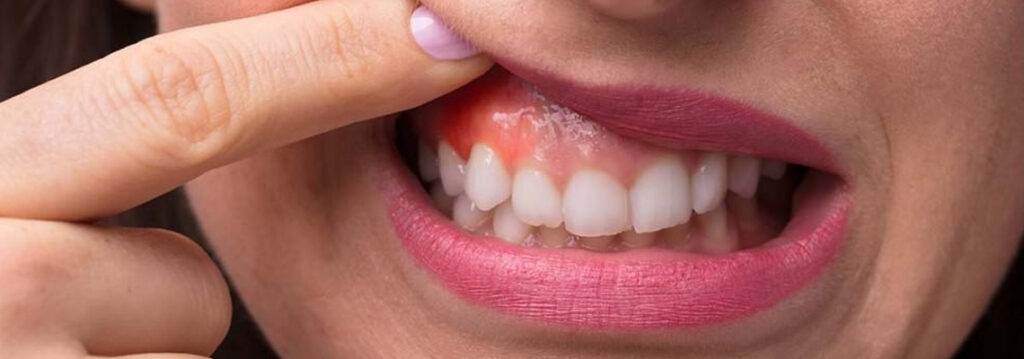 Treatment of Infected Gums | Dr. Motiwala