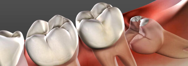 How Well Do You Know Your Wisdom Teeth? | Dr. Motiwala Dental Clinic ...
