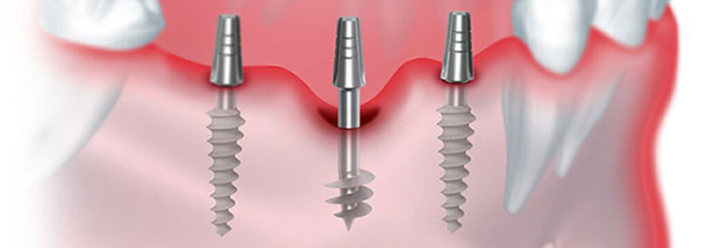Prognosis of a Polished Surface Basal Implant | Dr. Motiwala Dental ...