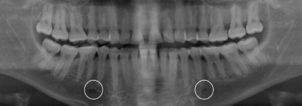 Radiographic Identification of Unilateral Accessory Mental Foramen | Dr ...