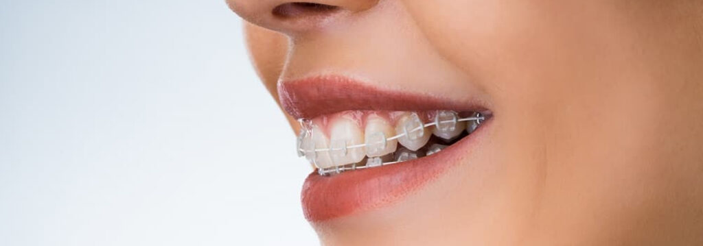 Overbite and Ways to Fix it | Dr. Motiwala