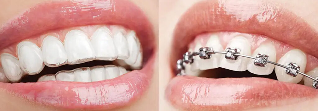 An Overview of Orthodontics | Dr. Motiwala