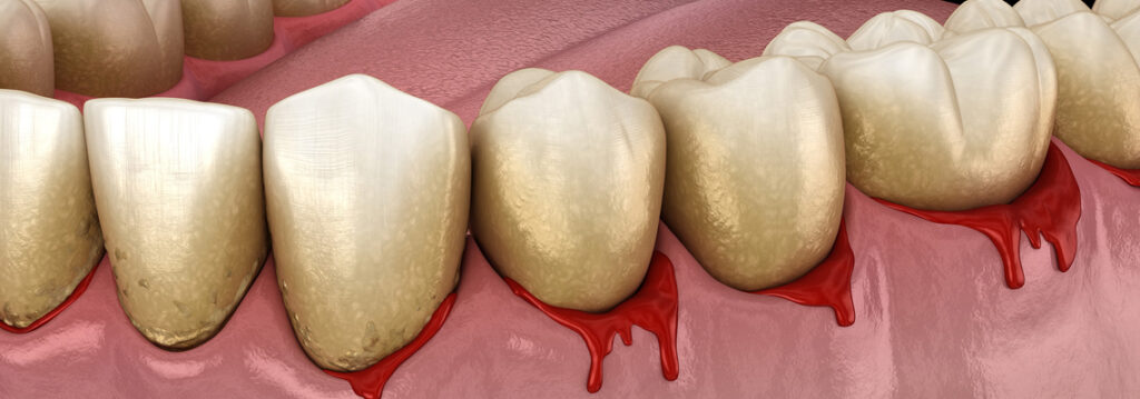 Do Not Ignore Bleeding Gums | Dr. Motiwala